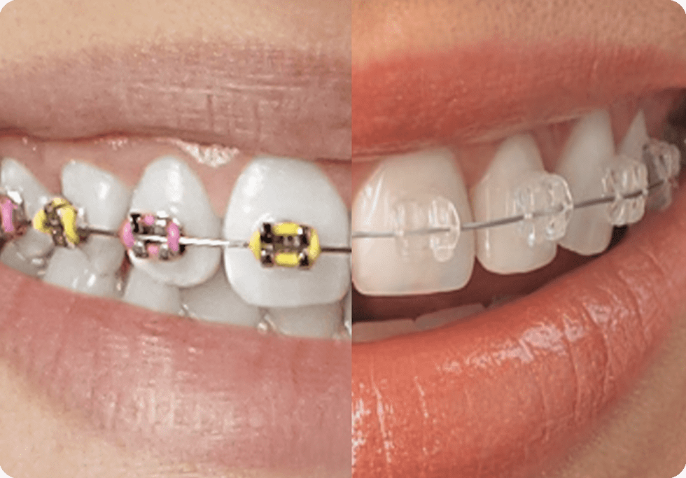 Metal & Ceramic Braces – Abay Orthodontics